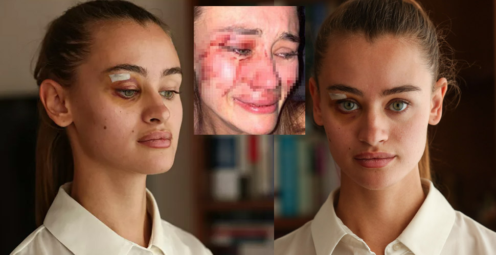Ukraynalı model Daria Kyryliuk darp iddiasıyla ilgili ilk kez konuştu ...
