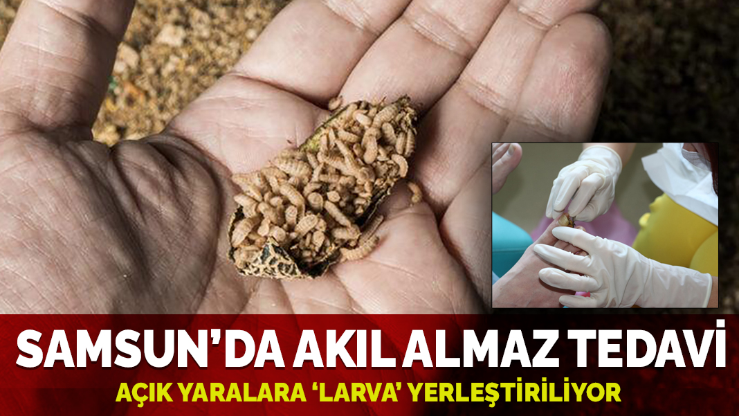 Samsun'da akılalmaz tedavi: Açık yaralara 'larva' yerleştiriliyor - KARAR