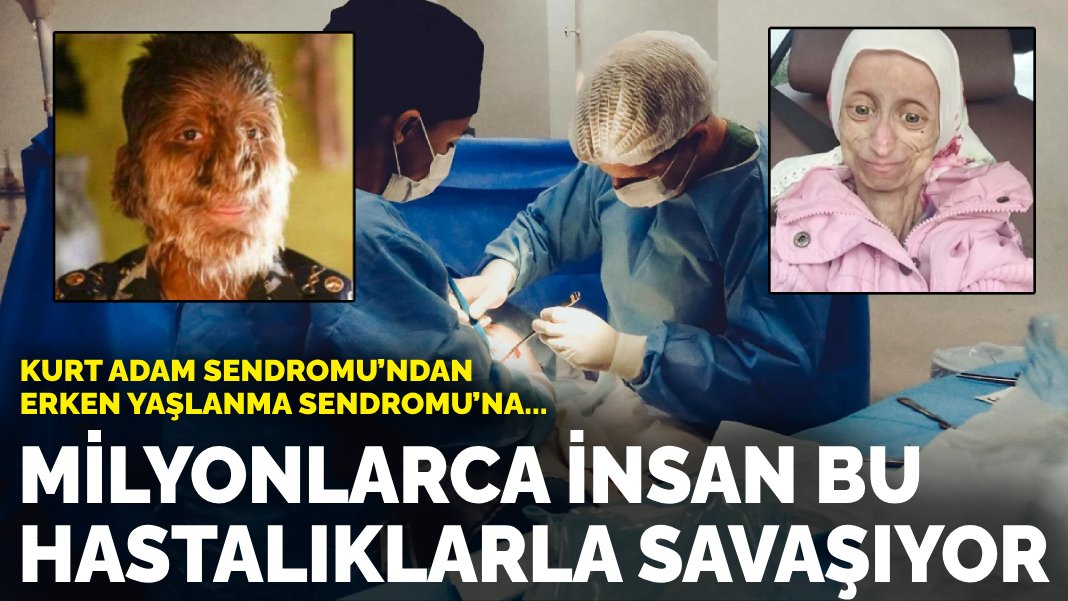 Erken Yaşlanma Sendromu’ndan Kurt Adam Sendromu’na… Dünyada milyonlarca ...