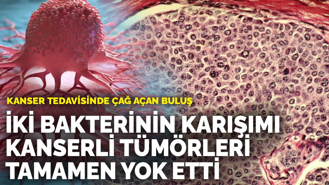 Kanser tedavisinde çağ açan buluş: İki bakterinin karışımı, kanserli ...